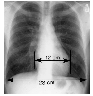 흉부 X-ray 후려치기(2) : 심장과 관련된 X-ray 소견 (CT ratio, LA enlargement, LV ...