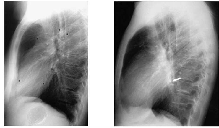흉부 X-ray 후려치기(2) : 심장과 관련된 X-ray 소견 (CT ratio, LA enlargement, LV ...