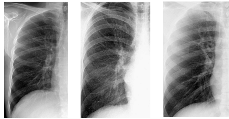 흉부 X-ray 후려치기(2) : 심장과 관련된 X-ray 소견 (CT ratio, LA enlargement, LV ...