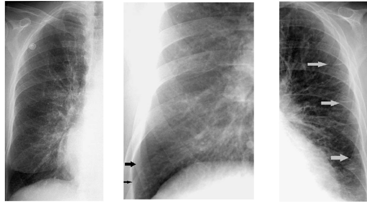흉부 X-ray 후려치기(2) : 심장과 관련된 X-ray 소견 (CT ratio, LA enlargement, LV ...