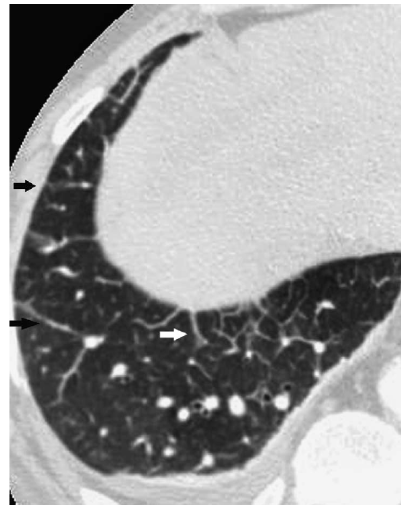 흉부 X-ray 후려치기(2) : 심장과 관련된 X-ray 소견 (CT ratio, LA enlargement, LV ...