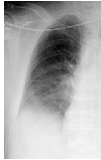 흉부 X-ray 후려치기(2) : 심장과 관련된 X-ray 소견 (CT ratio, LA enlargement, LV ...