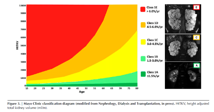 보통염색체우성 다낭콩팥병 (상염색체우성 다낭성 콩팥병, ADPKD) (4) 치료 : 보존적치료, 고위험군 치료 – 손닥터